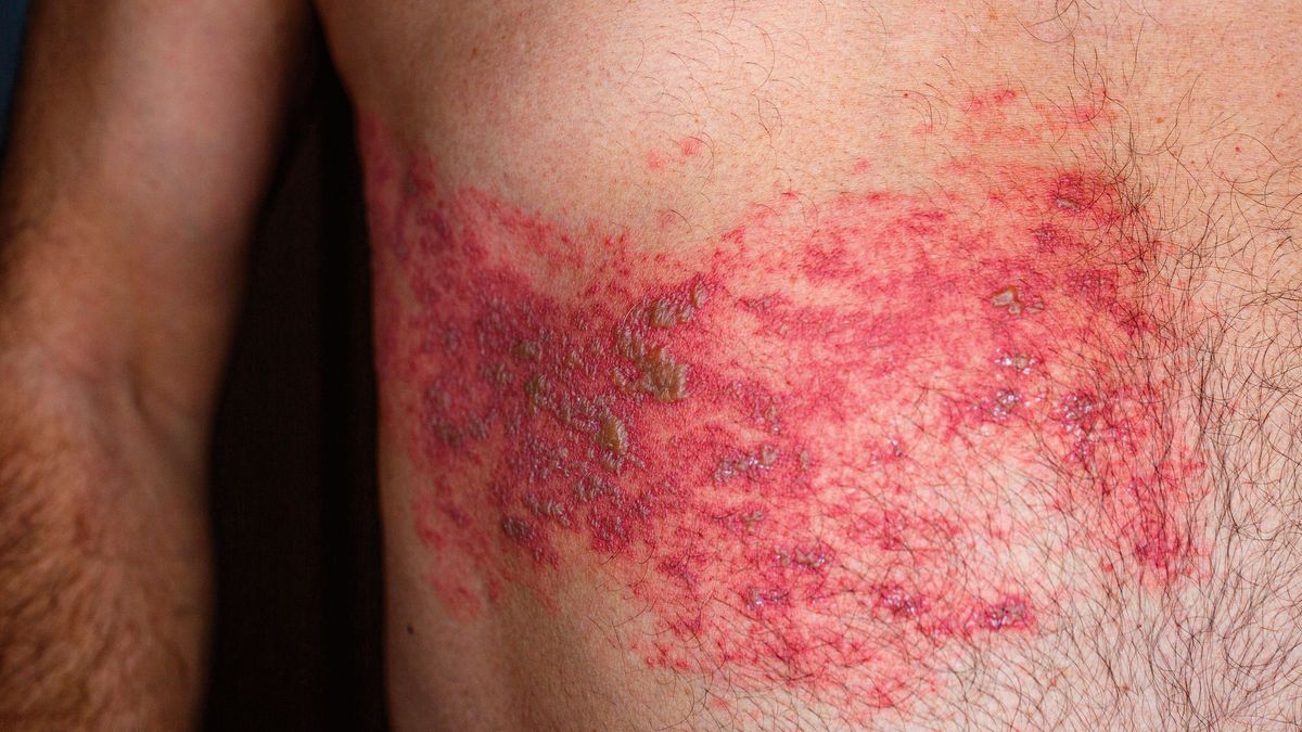 Schmerzbehandlung bei Herpes Zoster